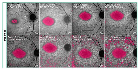 Natural History of Stargardt Disease: The Longest Follow-Up Cohort Study