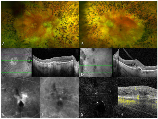 Retinal Angiomatous Proliferation in a Patient with Retinitis Pigmentosa