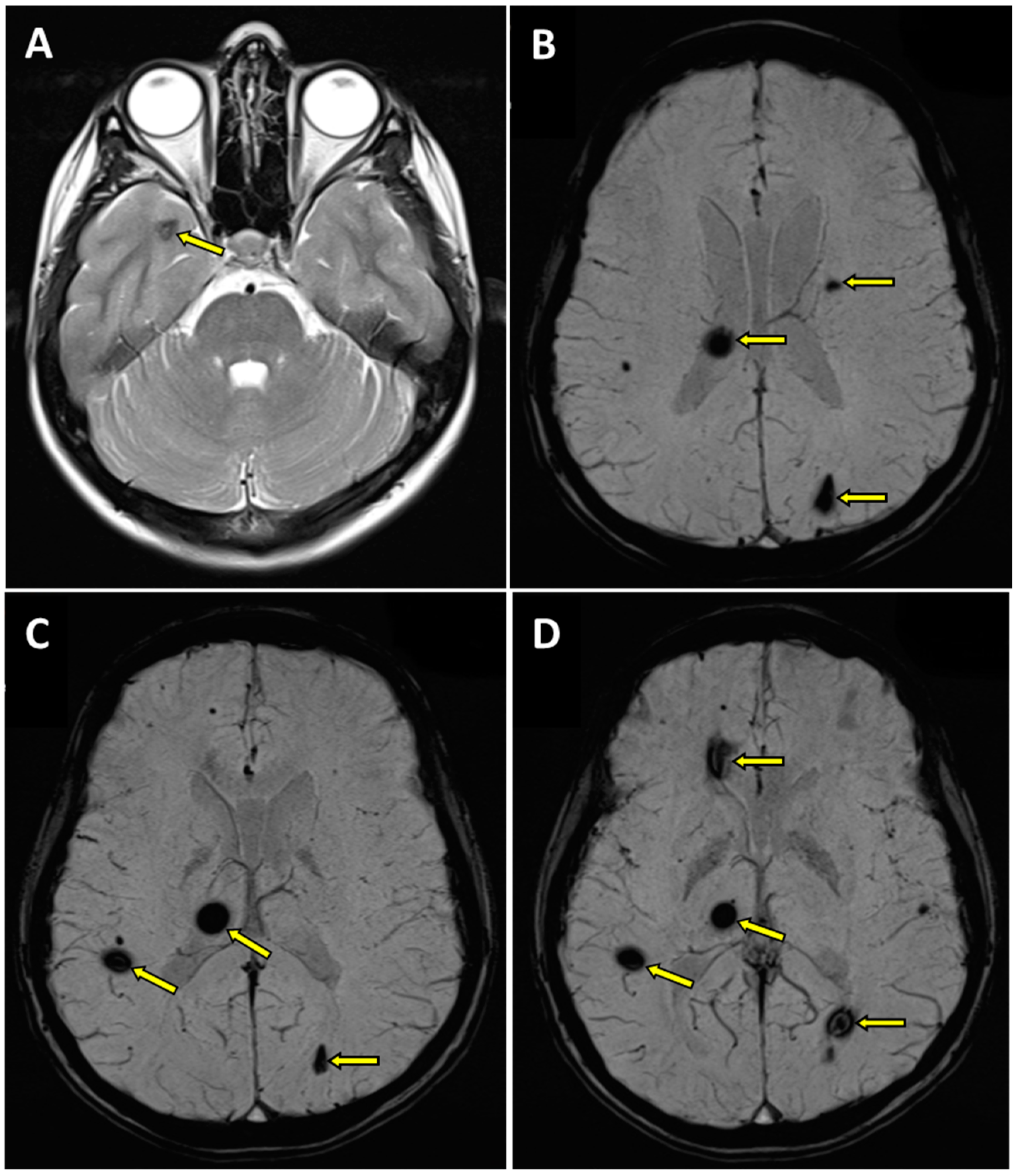 The First Potentially Causal Genetic Variant Documented in a Polish ...