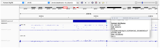 16p11.2 Microduplication Syndrome with Increased Fluid in the Cisterna ...
