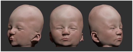 16p11.2 Microduplication Syndrome with Increased Fluid in the Cisterna ...