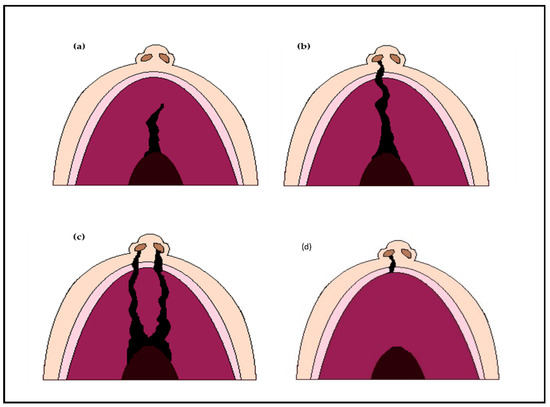 Orofacial Clefts: Genetics of Cleft Lip and Palate