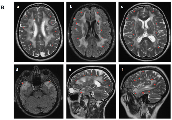 Four Novel Disease-Causing Variants in the NOTCH3 Gene in Russian ...
