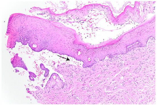 Independent COL17A1 Variants in Cats with Junctional Epidermolysis Bullosa