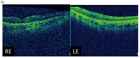 Identification of the RPGR Gene Pathogenic Variants in a Cohort of ...