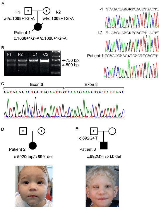 Novel Loss of Function Variants in CENPF Including a Large Intragenic Deletion in Patients with ...