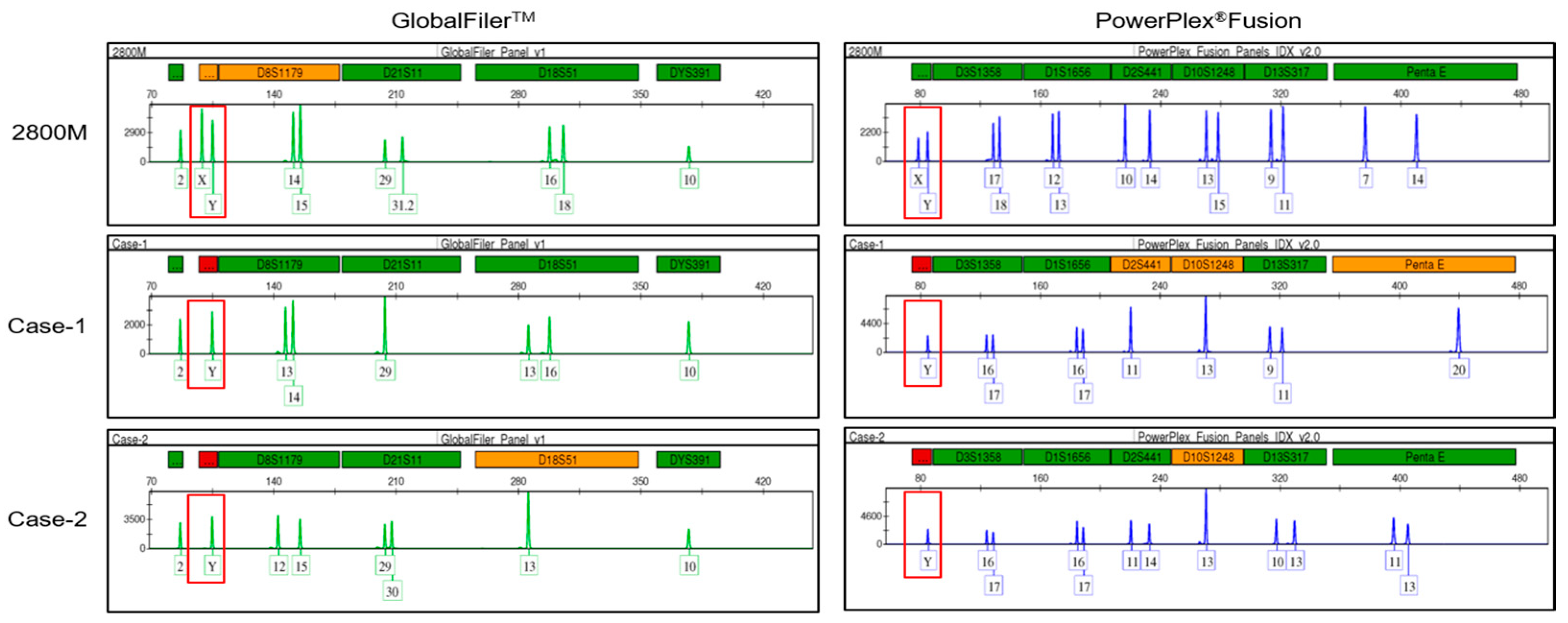 Amplification Failure of the Amelogenin X Gene Caused by a Rare ...