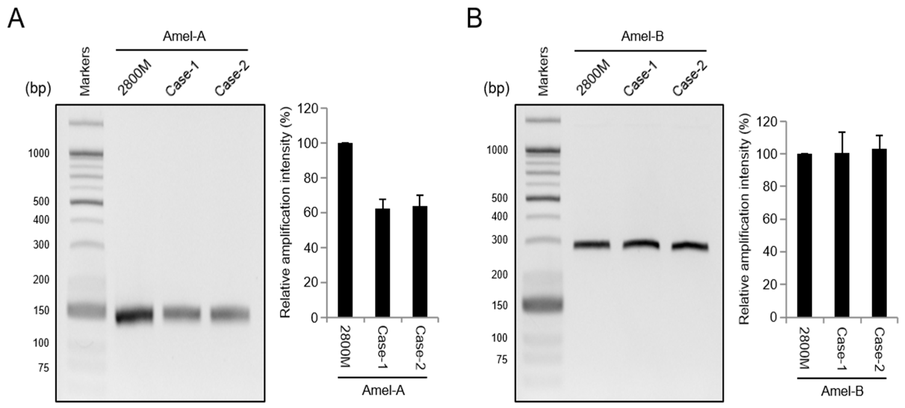 Amplification Failure of the Amelogenin X Gene Caused by a Rare ...