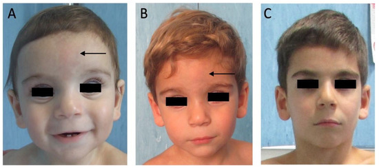 First Case of a Dominant De Novo SEC23A Mutation with Neurological and ...