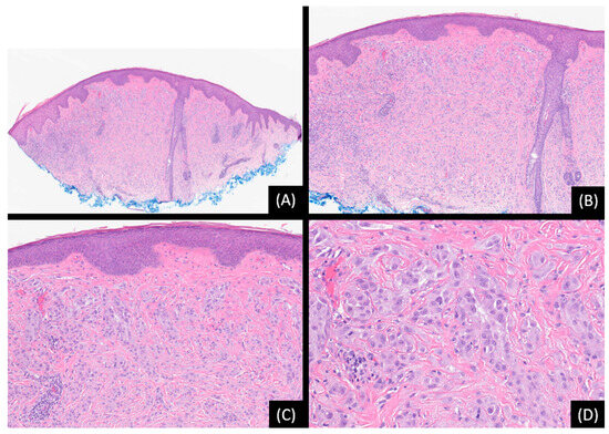 Spitz Melanocytic Tumors: A Fascinating 75-Year Journey
