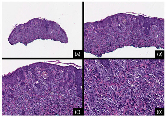 Spitz Melanocytic Tumors: A Fascinating 75-Year Journey