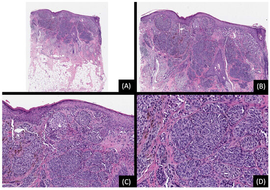 Spitz Melanocytic Tumors: A Fascinating 75-Year Journey