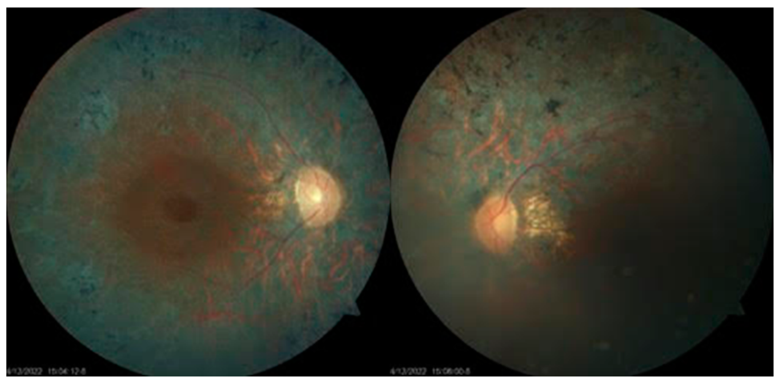 Syndromic Retinitis Pigmentosa: A 15-Patient Study