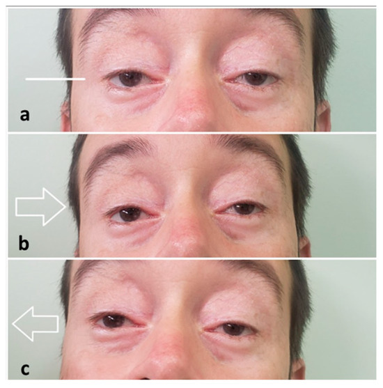 Syndromic Retinitis Pigmentosa: A 15-Patient Study