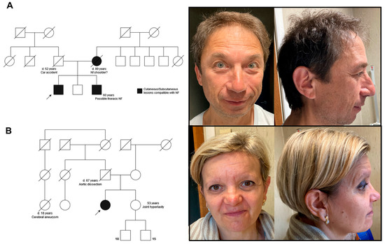 Phenotypic Expansion of Autosomal Dominant LZTR1-Related Disorders with ...