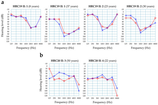 Genes | Free Full-Text | Novel Cases of Non-Syndromic Hearing ...