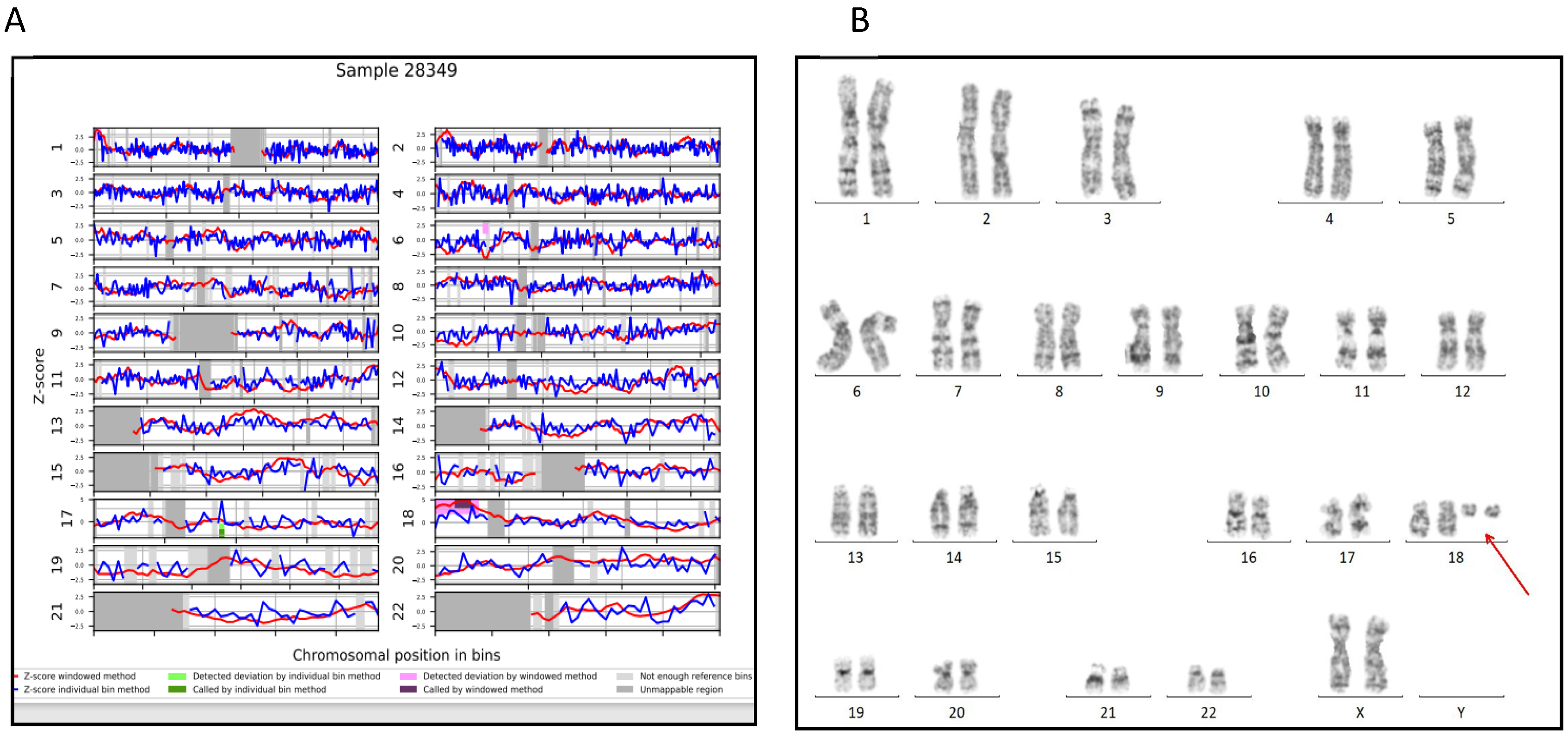 Inherited Unbalanced Reciprocal Translocation with 18p11.32p11.21 ...