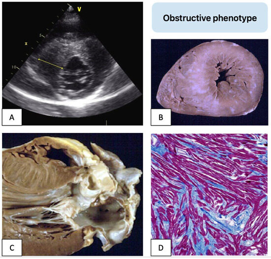 Hypertrophic Cardiomyopathy: New Clinical and Therapeutic Perspectives ...