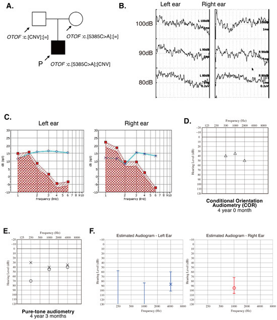 Auditory Neuropathy Caused by a Structural Variation in the OTOF Gene ...
