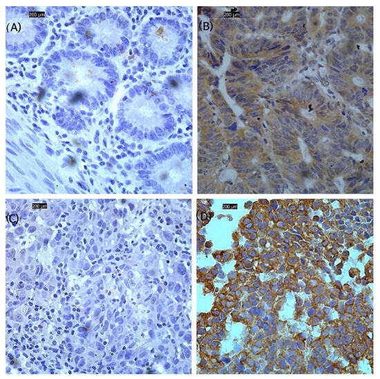 Clinical Significance of Fragile X Syndrome 2 (FXR2) in Breast Cancer