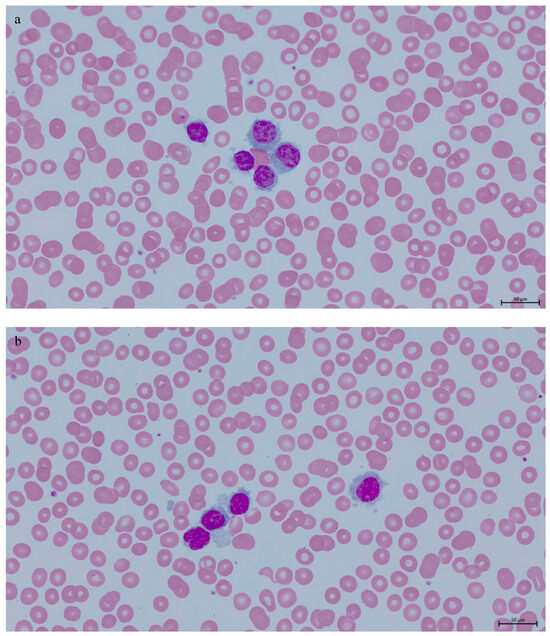 Splenic Diffuse Red Pulp Small B-Cell Lymphoma with Overlapping ...