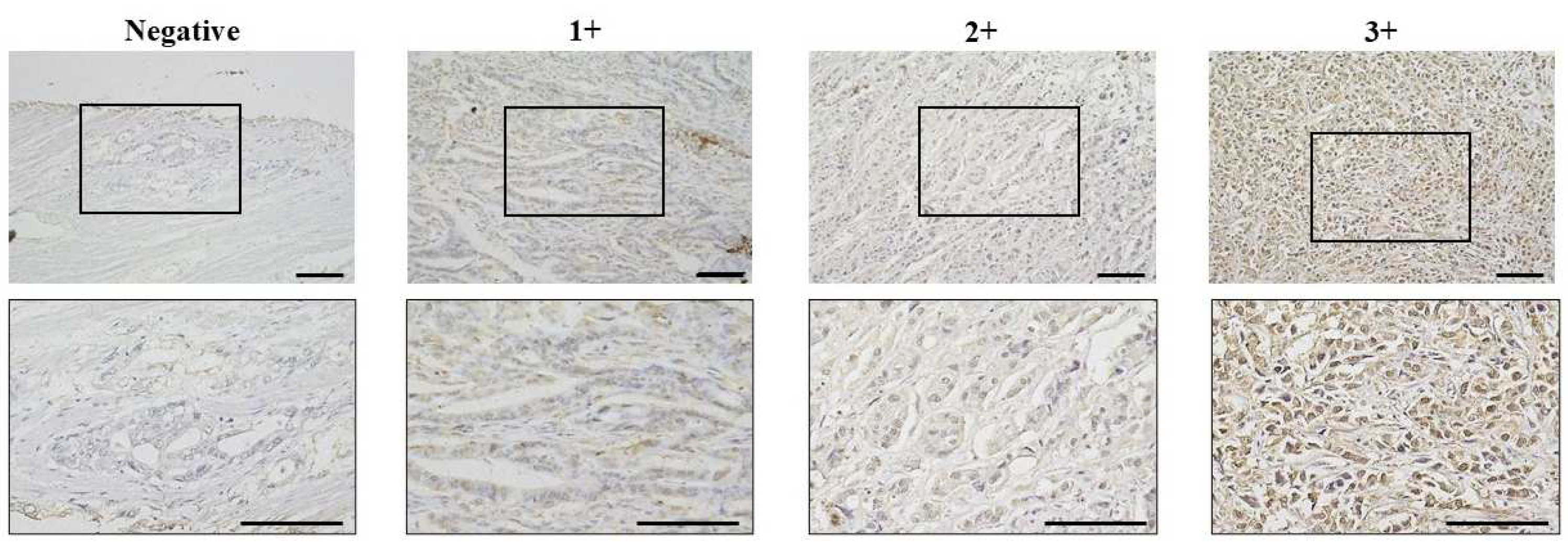 CCNE1 Gene Amplification Might Be Associated with Lymph Node Metastasis ...