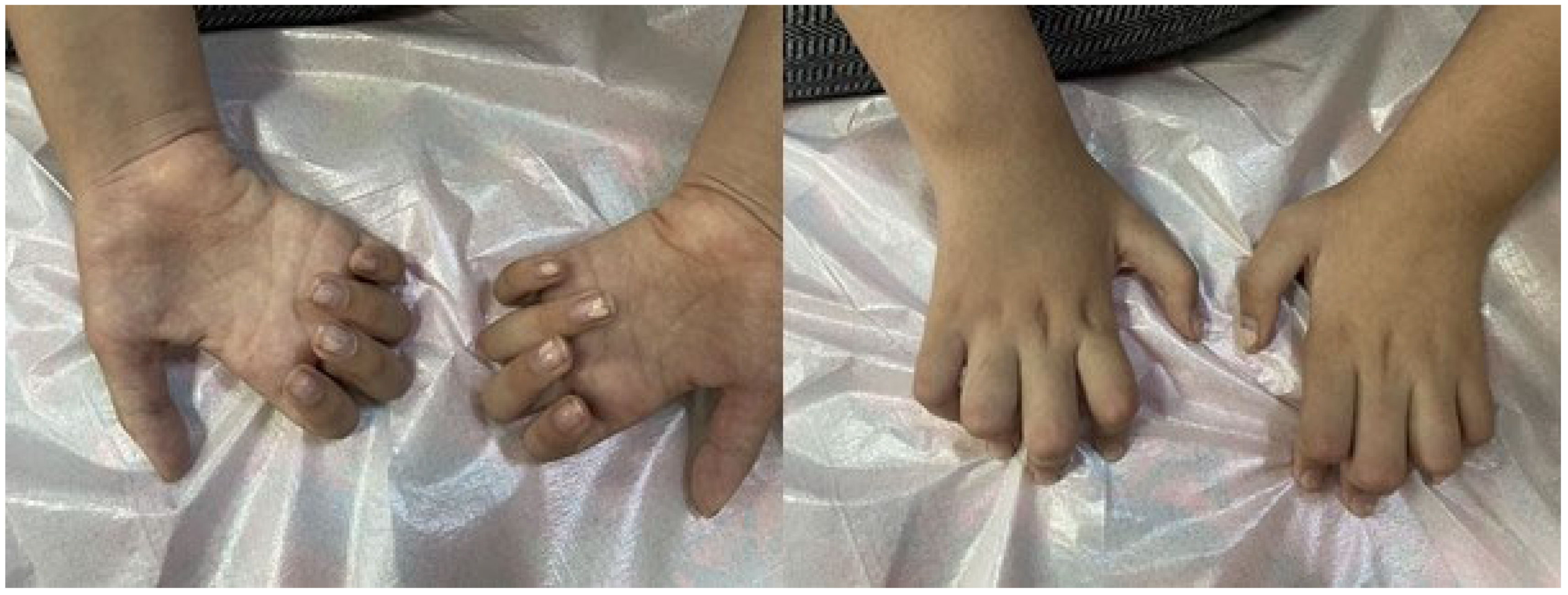 Genotypic and Phenotypic Characterization of Axonal Charcot–Marie–Tooth ...