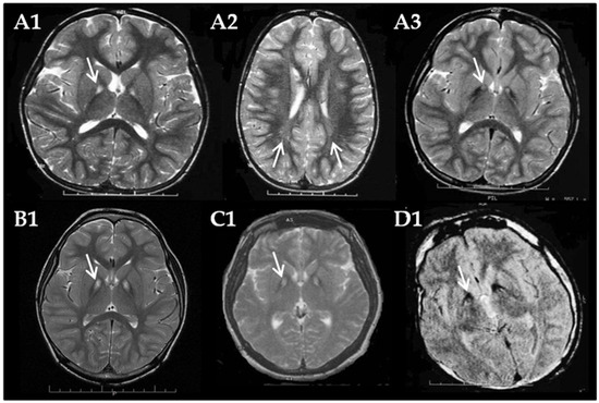 Focus on Clinical and Genetic Aspects of PKAN Through the Description ...