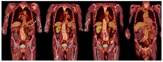 A Stab in the Dark: A Case Report of an Atypical Presentation of Giant ...