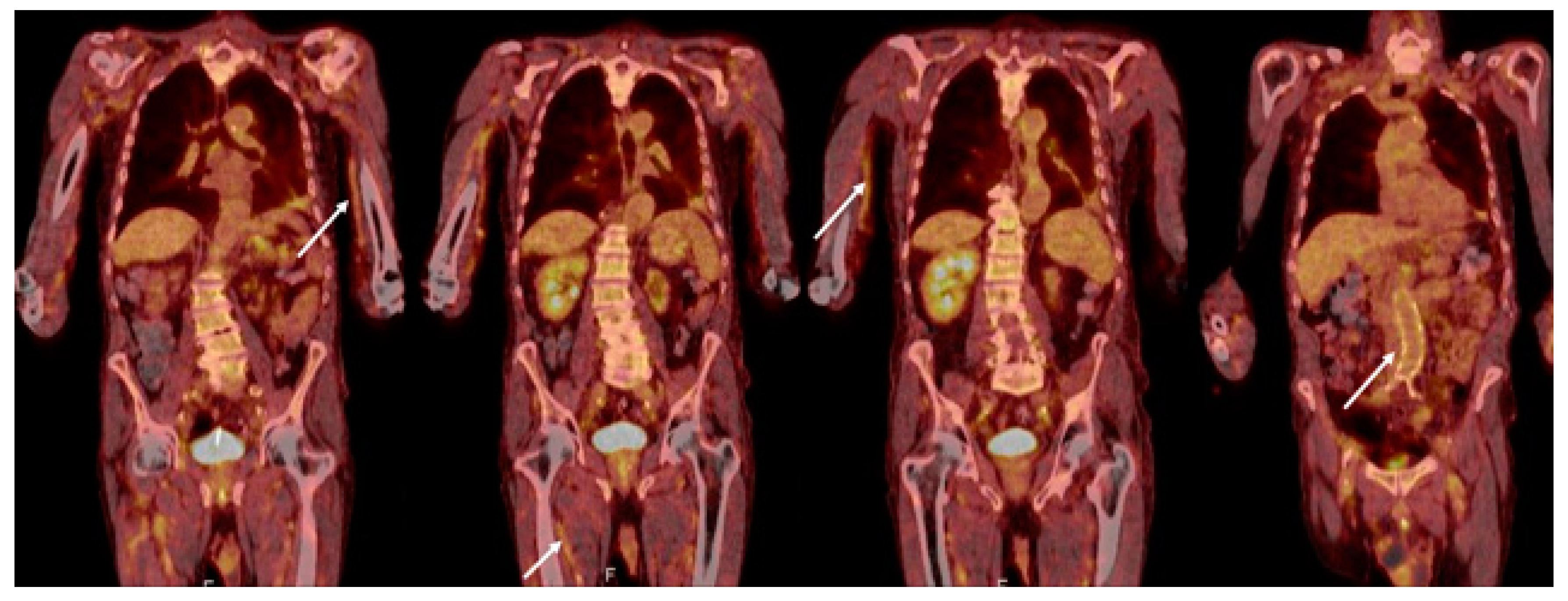 A Stab in the Dark: A Case Report of an Atypical Presentation of Giant ...