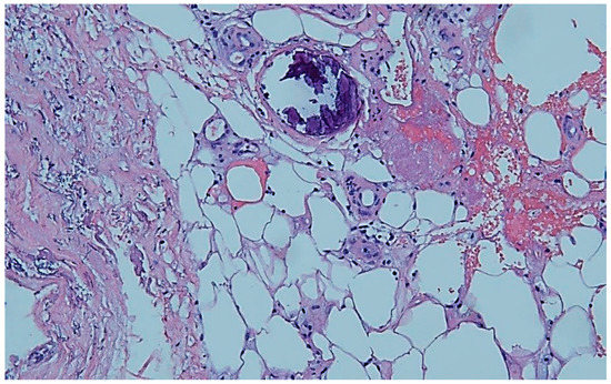 Calciphylaxis as A Rare Cause of A Chronic Wound in An 83-Year-Old Woman