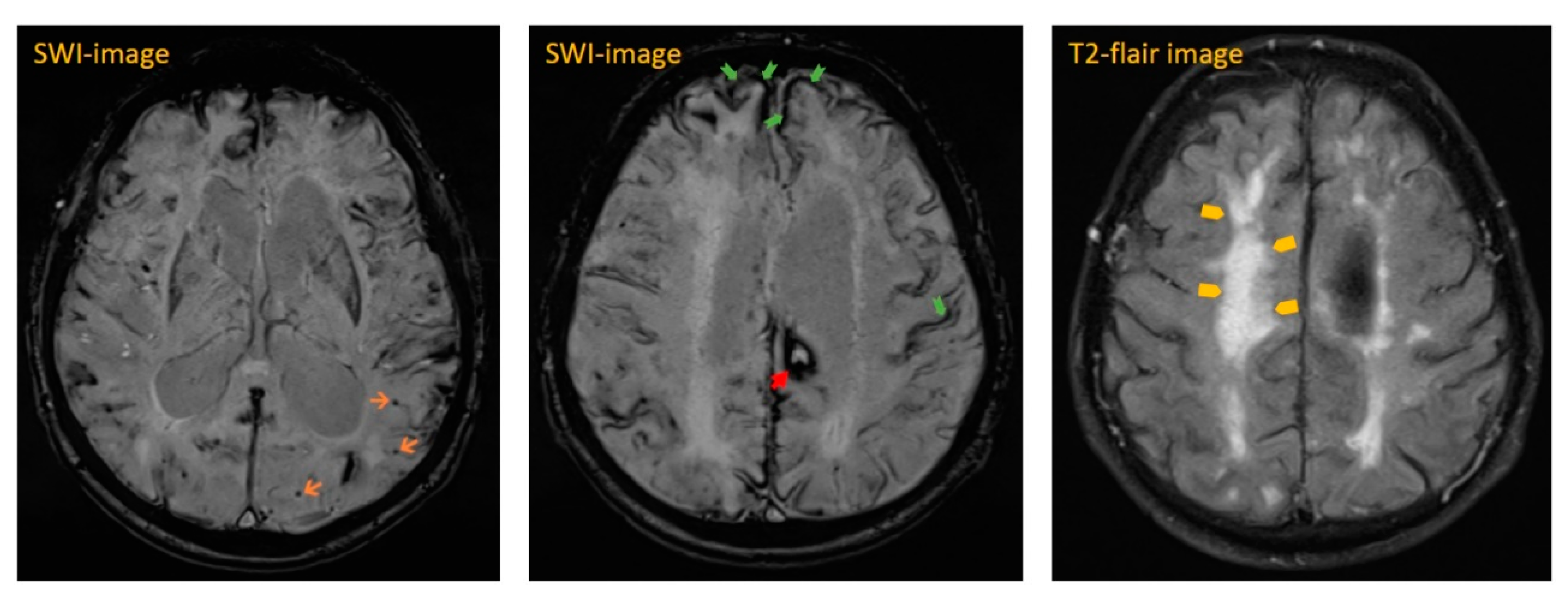Geriatrics | Free Full-Text | Rapid Cognitive Decline and Recurrent ...