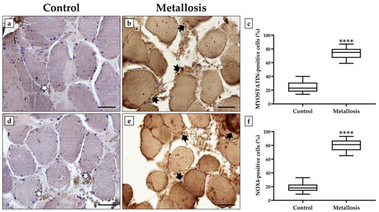 Geriatrics | Free Full-Text | Metallosis after Hip Arthroplasty Damages ...