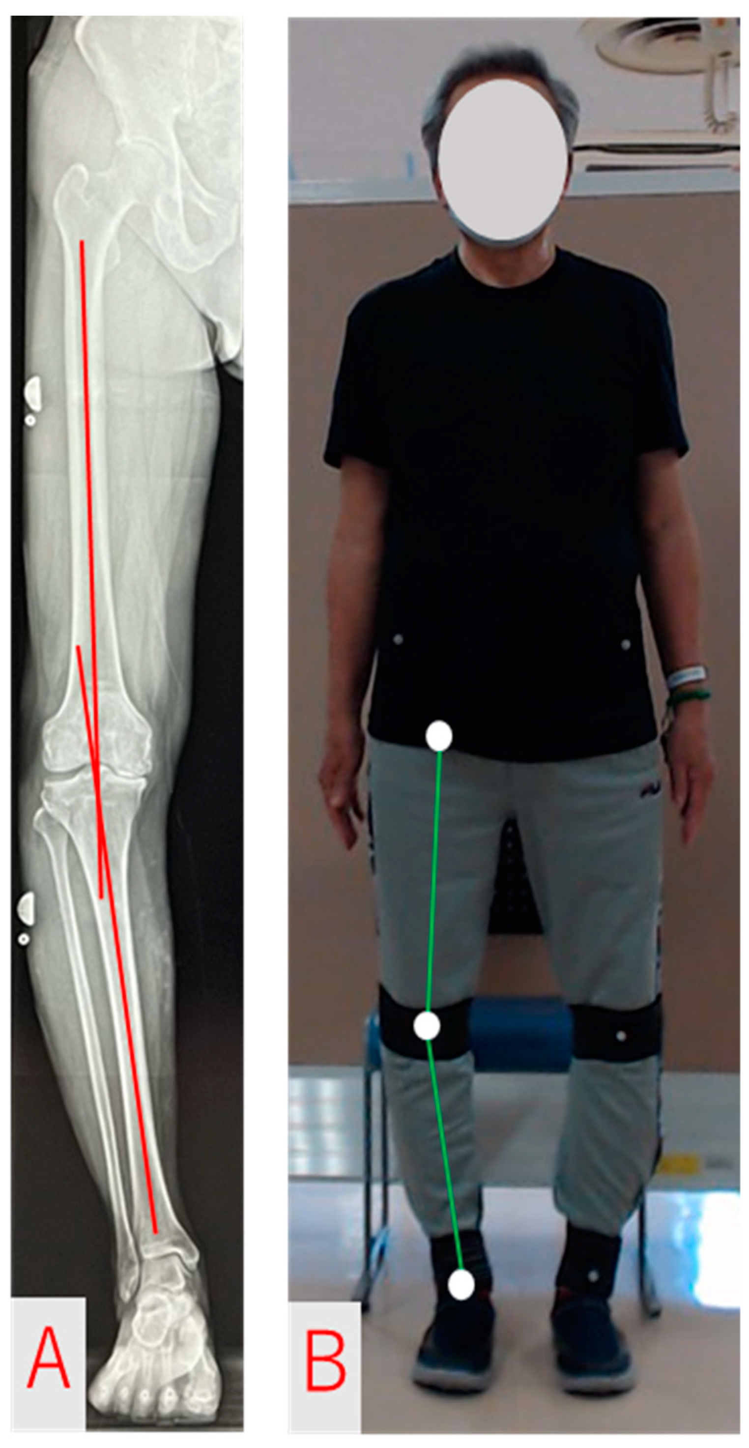 Validating Knee Varus Alignment Measurements Using Markerless Motion ...