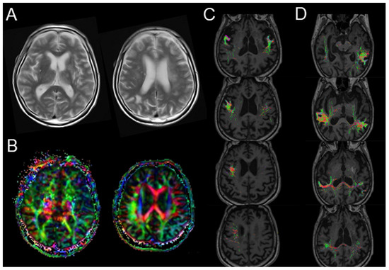 Diffusion MRI Fiber Tractography and Benzodiazepine SPECT Imaging for ...