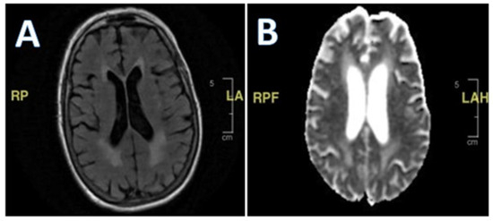 Case Report: Weakness and Recurrent Falls in an Older Patient
