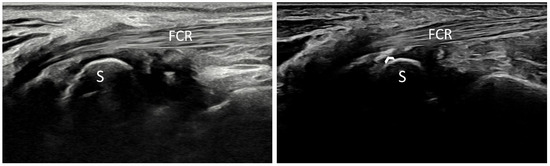 Optimizing the Use of Ultrasound in Calcium Pyrophosphate Deposition ...