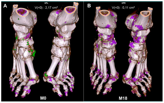 Imaging Follow-Up of MSU Crystal Depletion