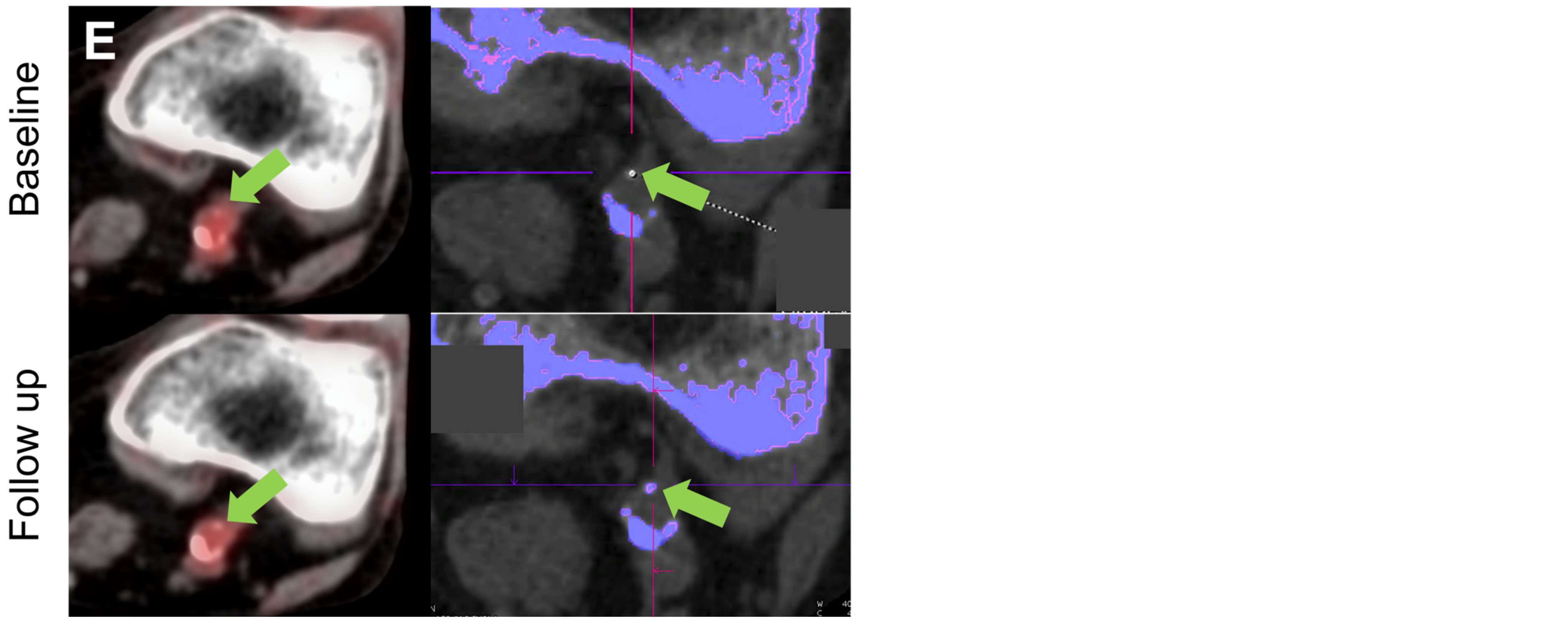 Assessing Changes in Vascular Inflammation and Urate Deposition in the ...