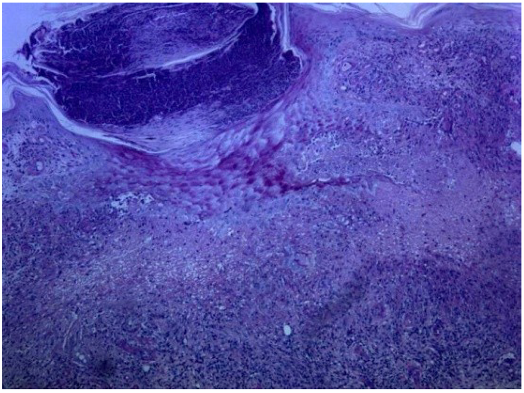 Perforating Granuloma Annulare — An Unusual Subtype of a Common Disease