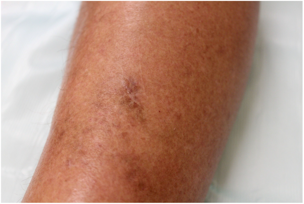 Perforating Granuloma Annulare — An Unusual Subtype of a Common Disease