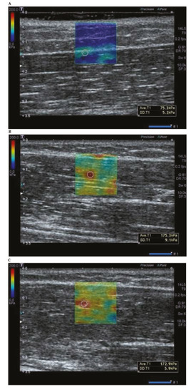 Healthcare | Free Full-Text | Feasibility of Ultrasound-Guided Trigger ...