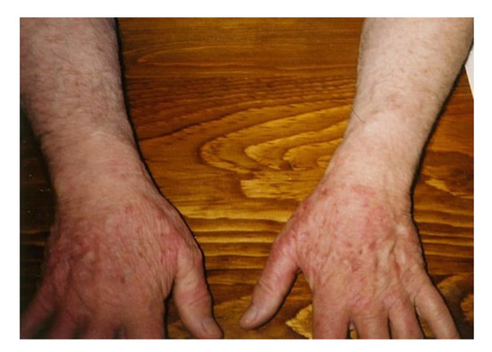 Presentation of Acrodermatitis Chronica Atrophicans Rashes on Lyme ...