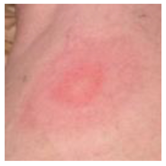 Presentation of Acrodermatitis Chronica Atrophicans Rashes on Lyme ...