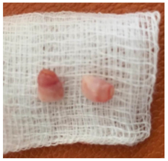 Natal and Neonatal Teeth: A Case Report and Mecanistical Perspective