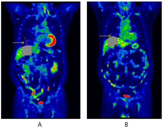 Image Registration of 18F-FDG PET/CT Using the MotionFree Algorithm and CT Protocols through ...