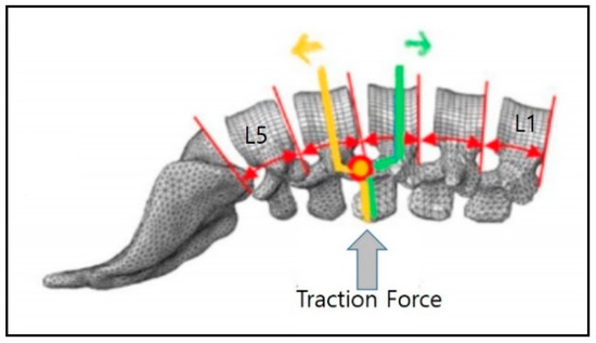 Mechanical Changes of the Lumbar Intervertebral Space and Lordotic ...