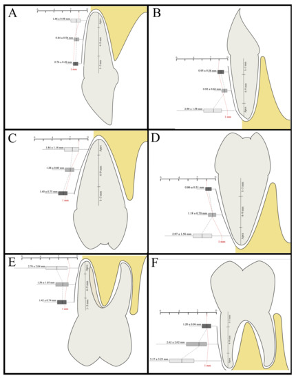 Buccal Bone Thickness in Anterior and Posterior Teeth—A Systematic Review
