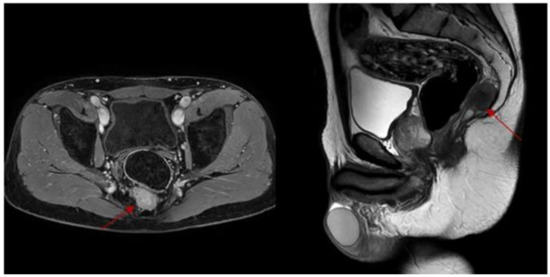 Promoting Laparoscopic Anterior Approach for a Very Low Presacral ...