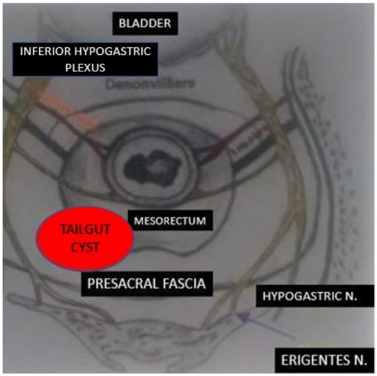 Promoting Laparoscopic Anterior Approach for a Very Low Presacral ...